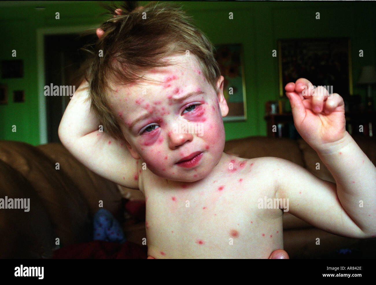 Young child with bad case of Chickenpox Stock Photo - Alamy