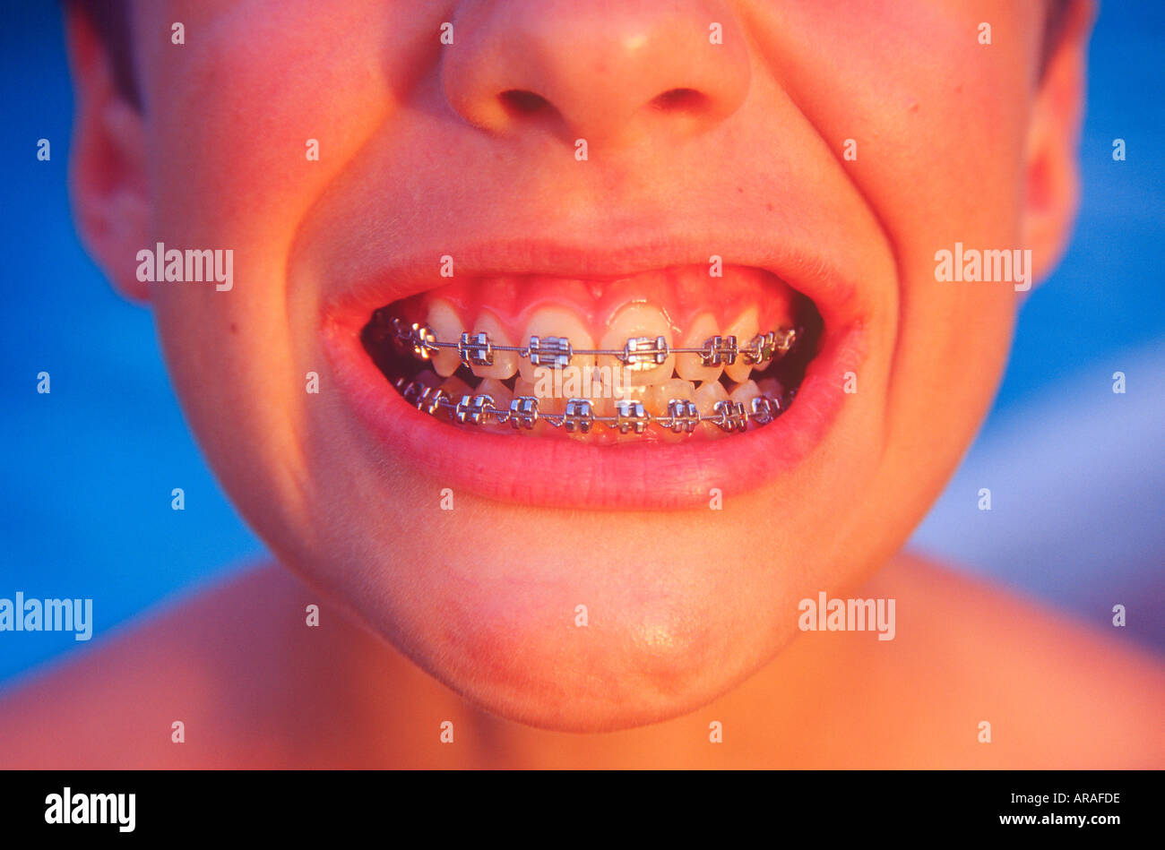 Boy with orthodontic braces Stock Photo - Alamy