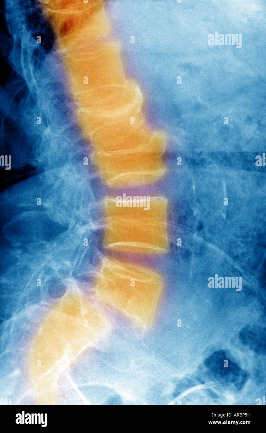 Lumbar Spine Xray Showing A Grade Ii Anterolisthesis Of L5 On S1 Stock
