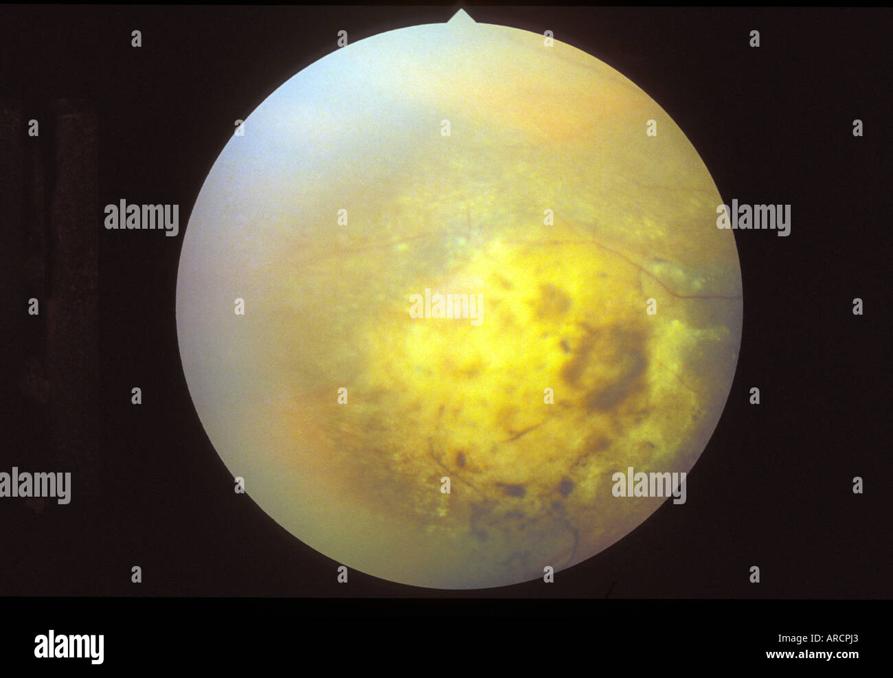 Retinal detachment hi-res stock photography and images - Alamy