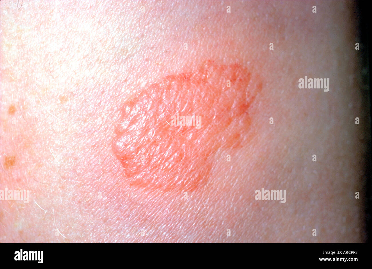 A Photograph Of A Reaction To The Tuberculin Skin Test Called A Stock 
