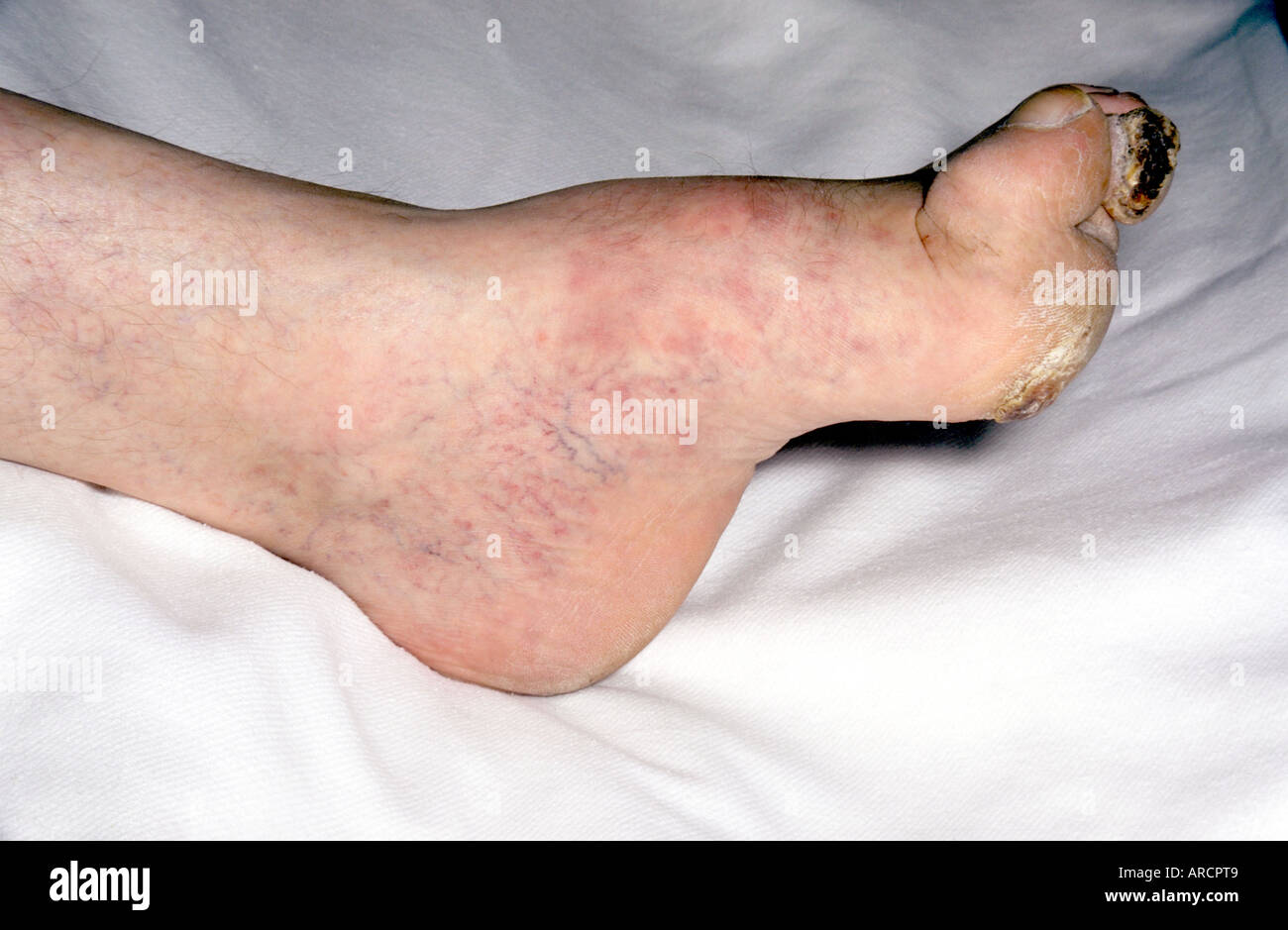 Diabetic Foot Neuropathy