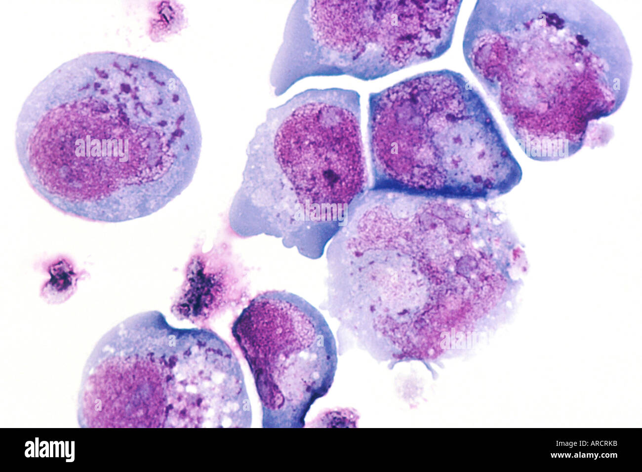 Histological slide of the human herpes virus-6 (HHV-6) previously known ...