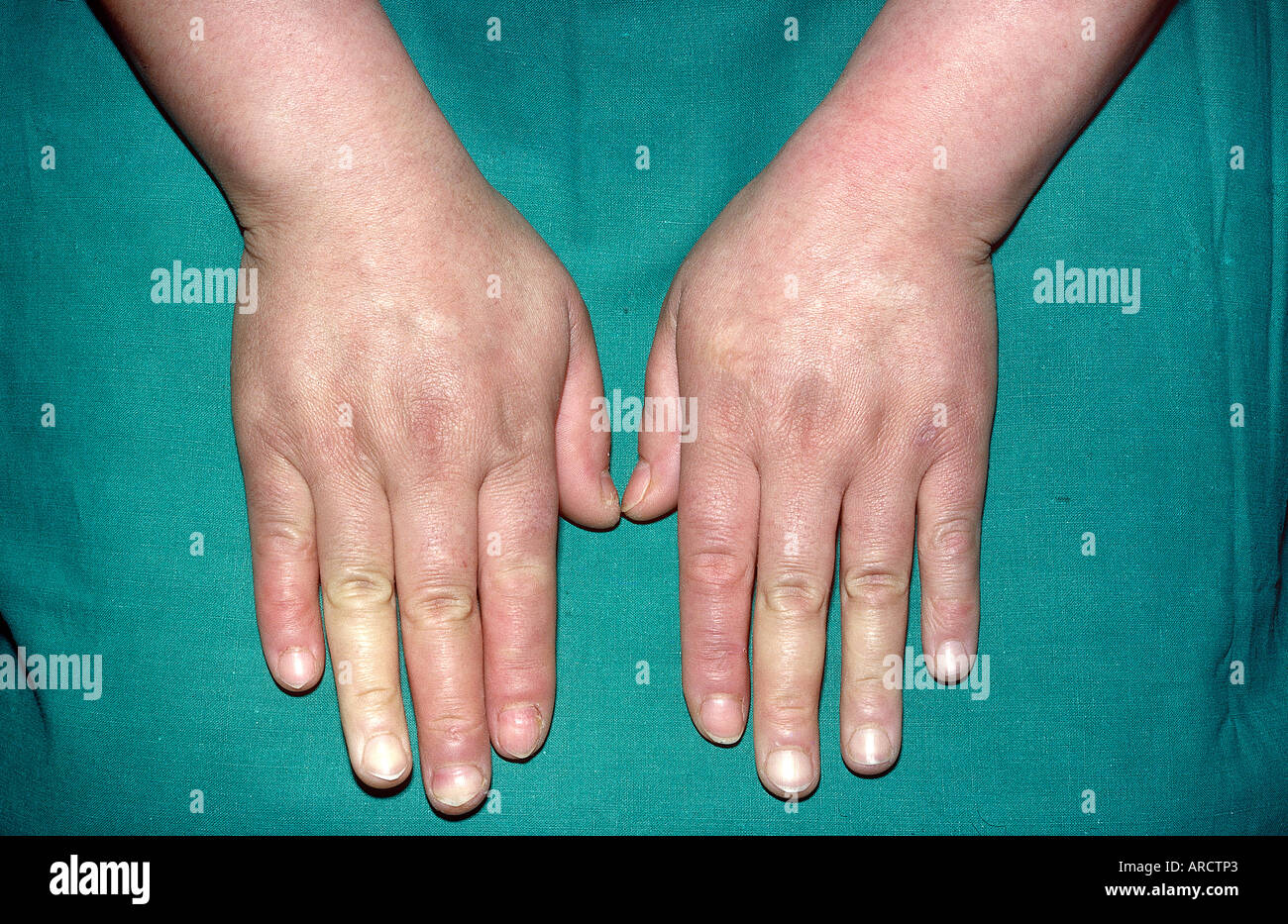 A photograph of the hands of a sufferer of Raynaud's phenomenon Stock ...