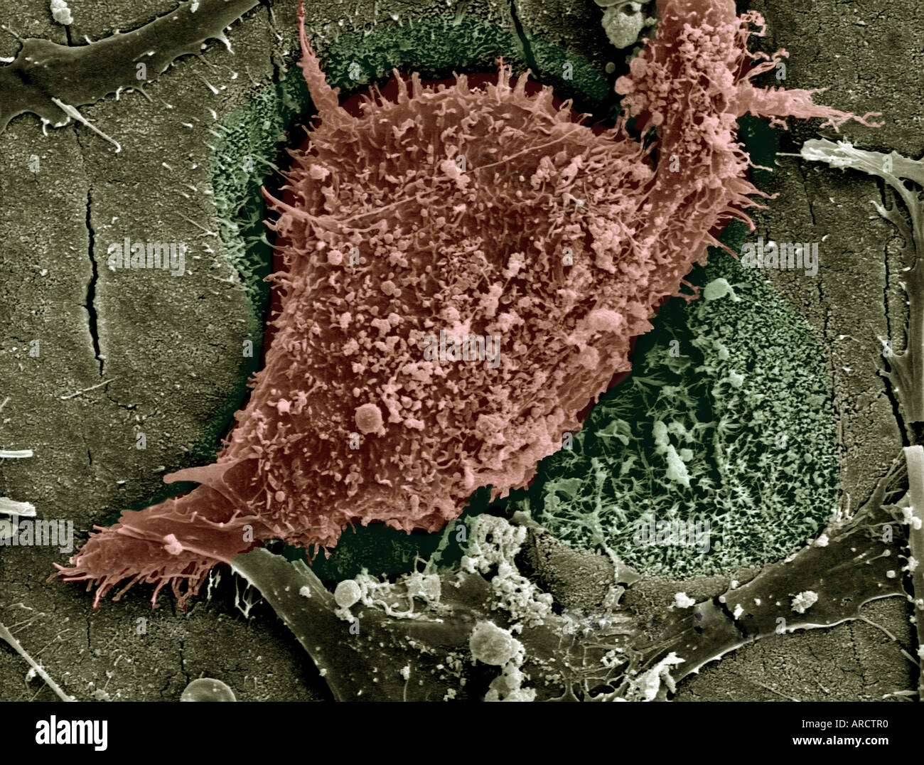 A scanning electron micrograph of an osteoclast reabsorbing bone ...