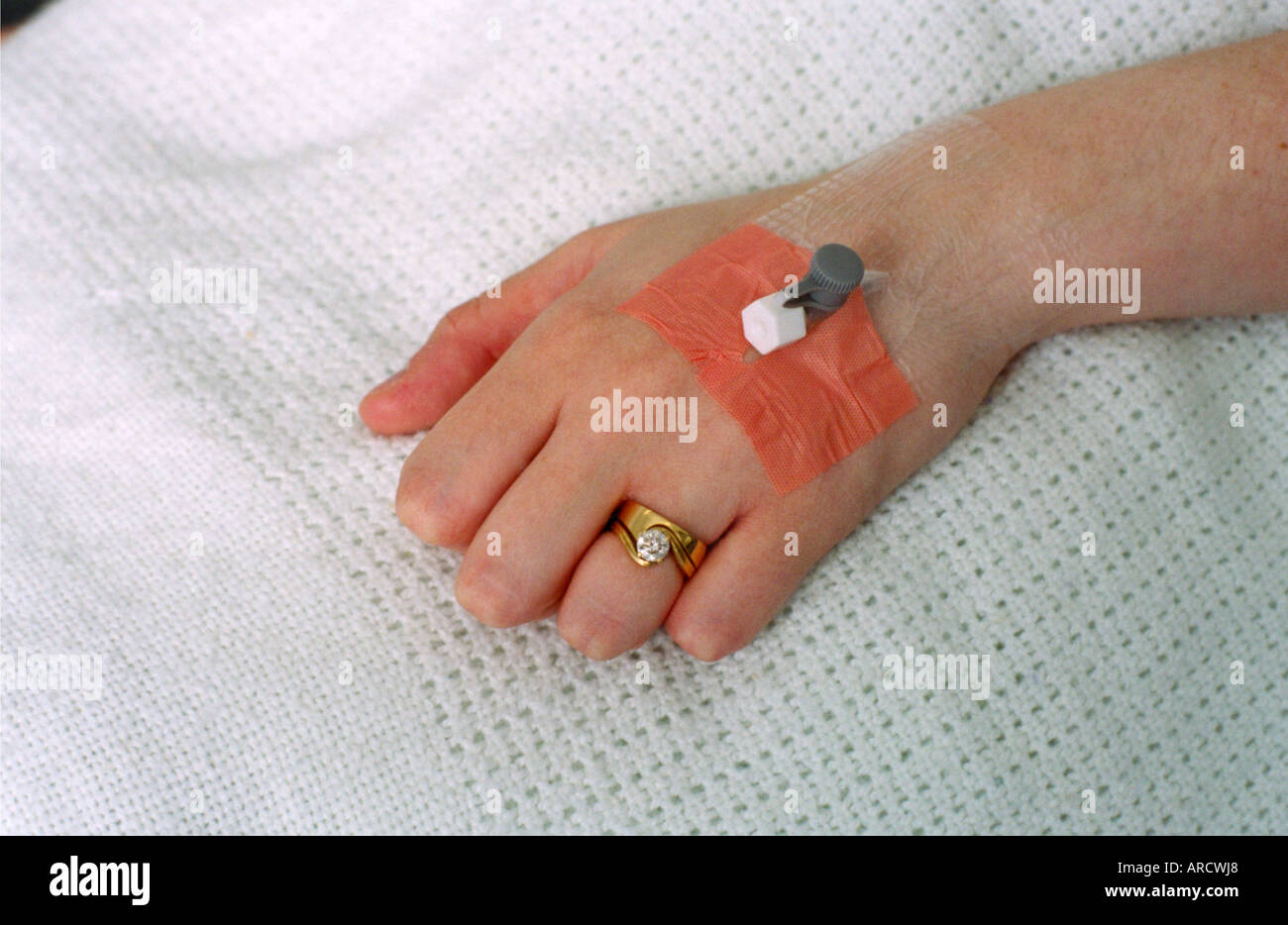 An intravenous cannula in place in the back of the hand of a female ...