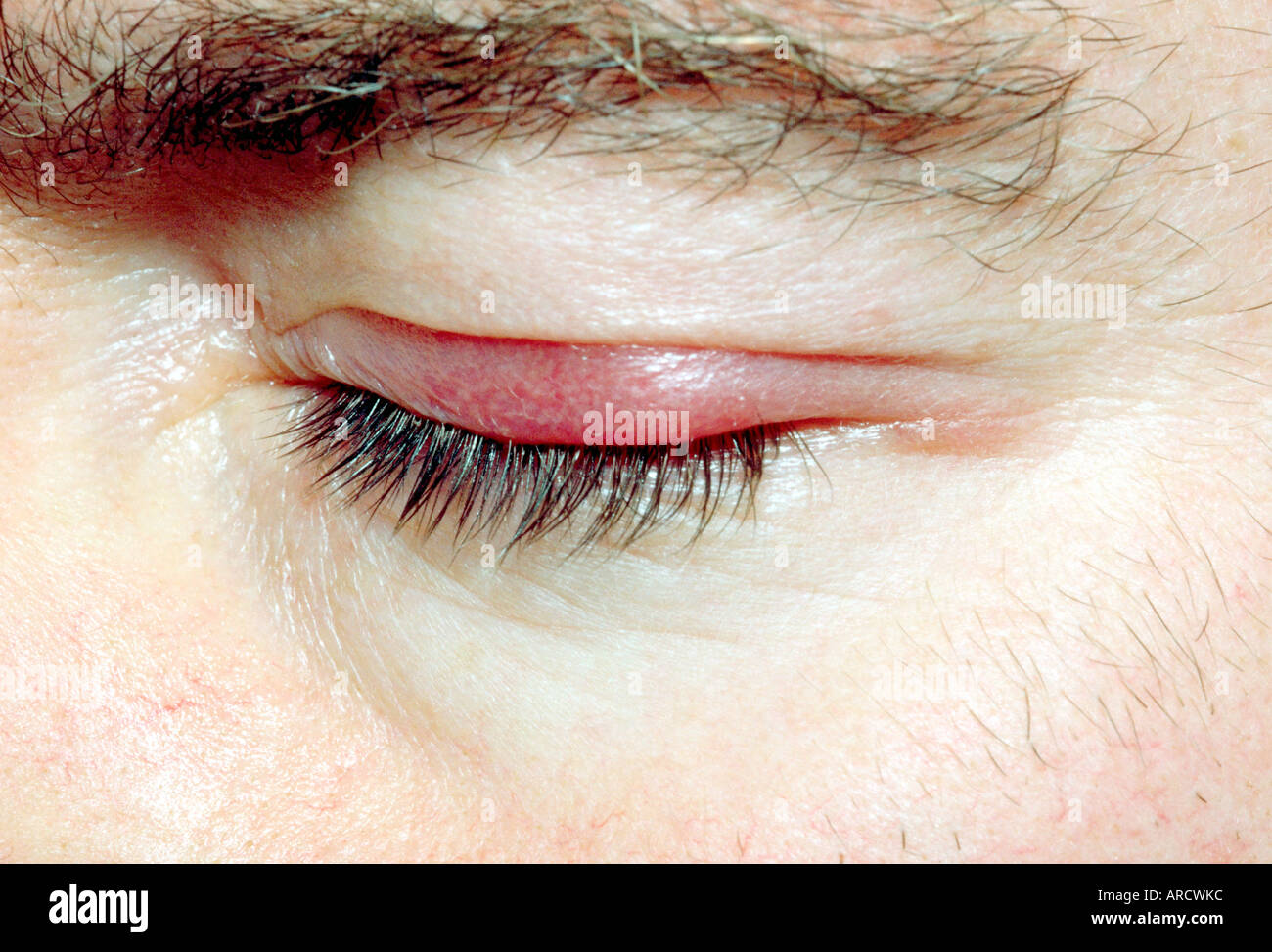 Blepharitis is inflammation of the eyelids Stock Photo - Alamy