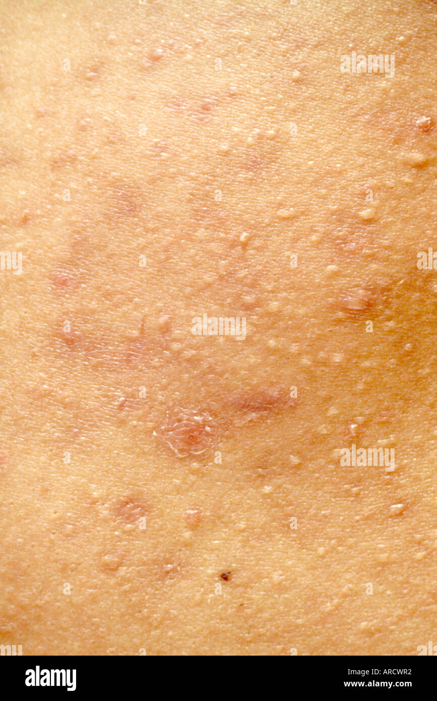 Acne vulgaris hi-res stock photography and images - Alamy
