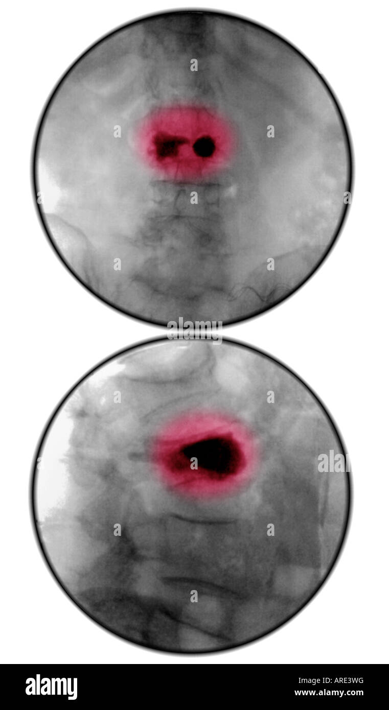 kyphoplasty of L3 vertebral body for compression fracture Stock Photo ...