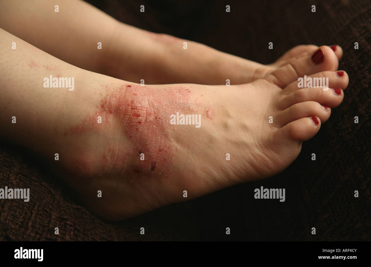 Allergic contact eczema (dermatitis) a red itchy weepy reaction Stock ...