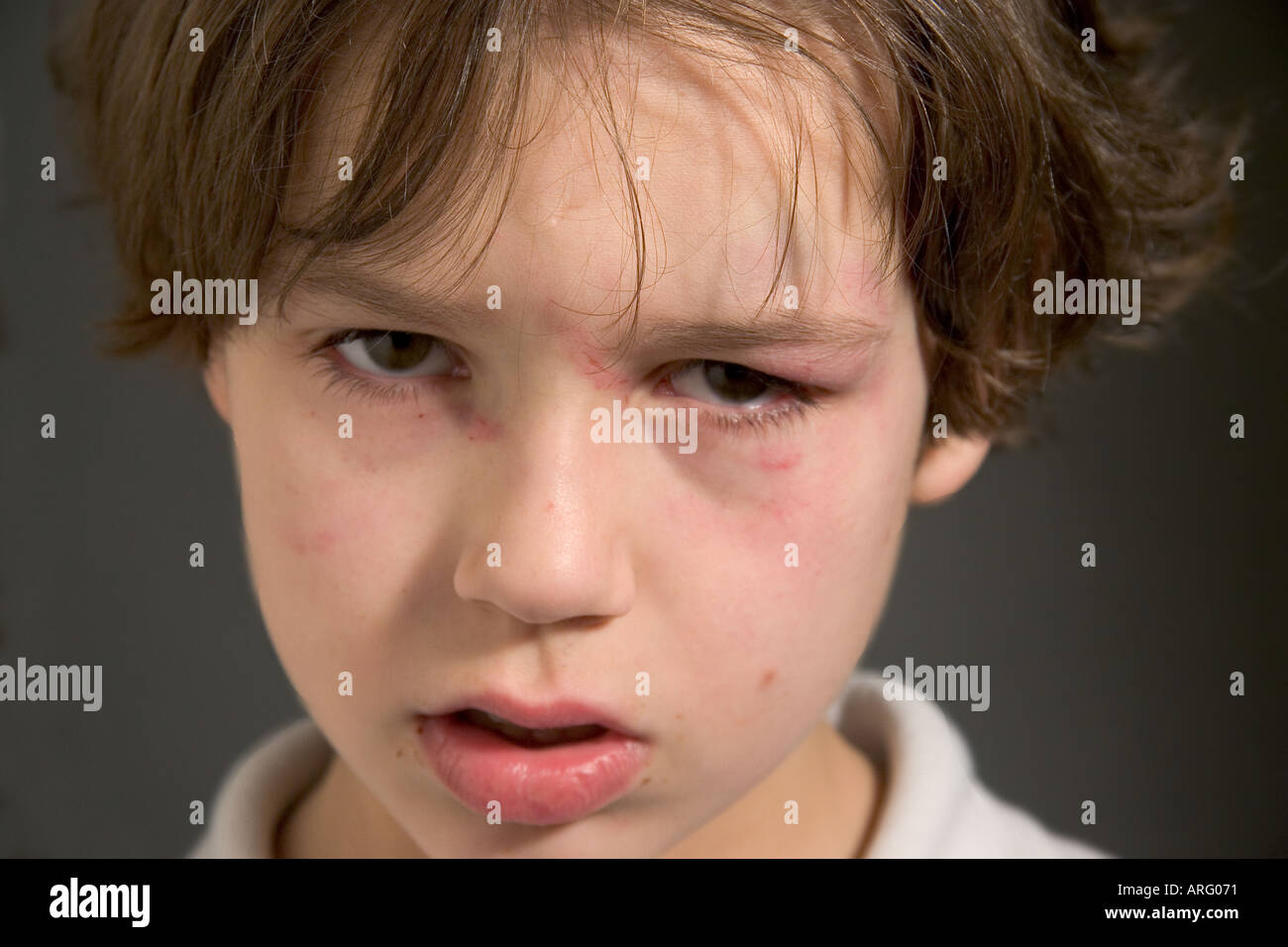 close up of boy 9 10 years with facial injuries received in a fight ...