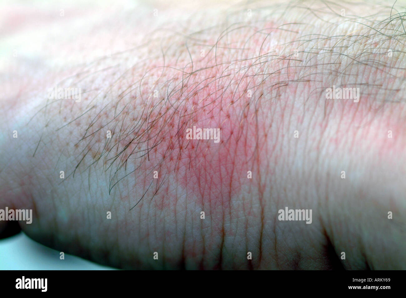 Fly bite man hi-res stock photography and images - Alamy