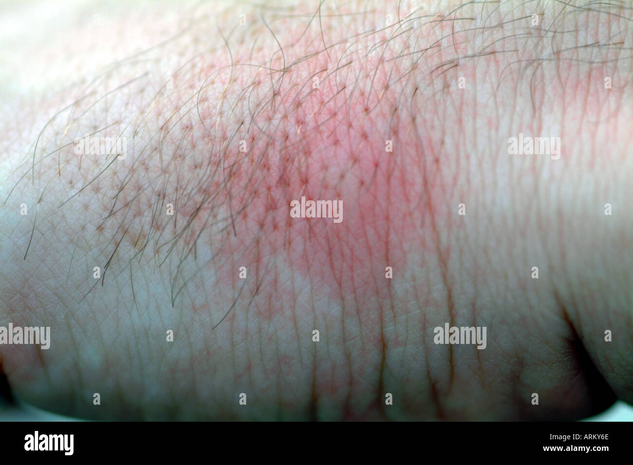 mosquito bite on the hand Stock Photo - Alamy