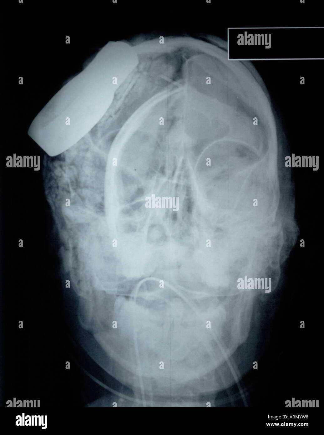 Head trauma skull fracture hi-res stock photography and images - Alamy
