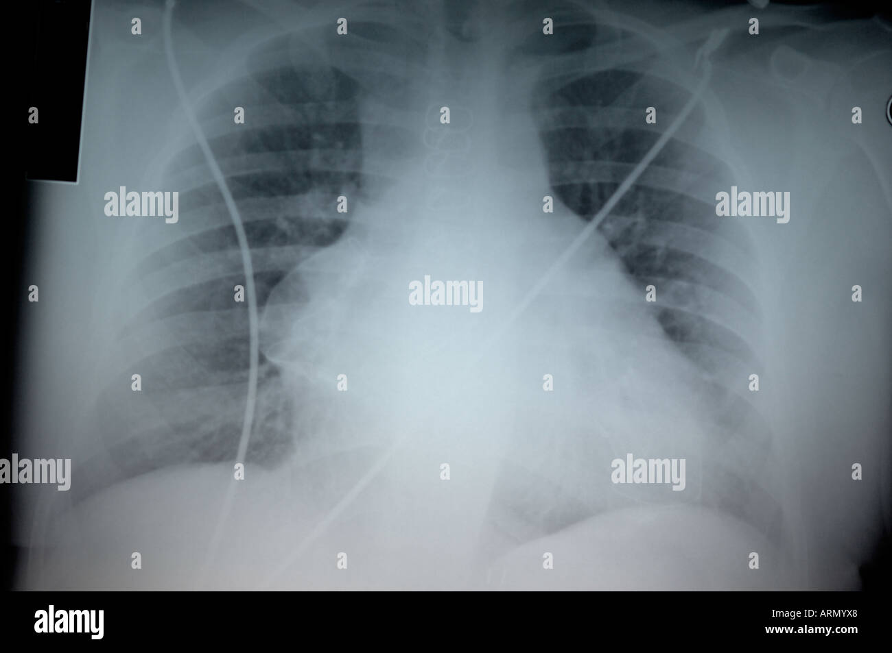 frontal chest x-ray of adult showing an atrial aneurysm Stock Photo - Alamy