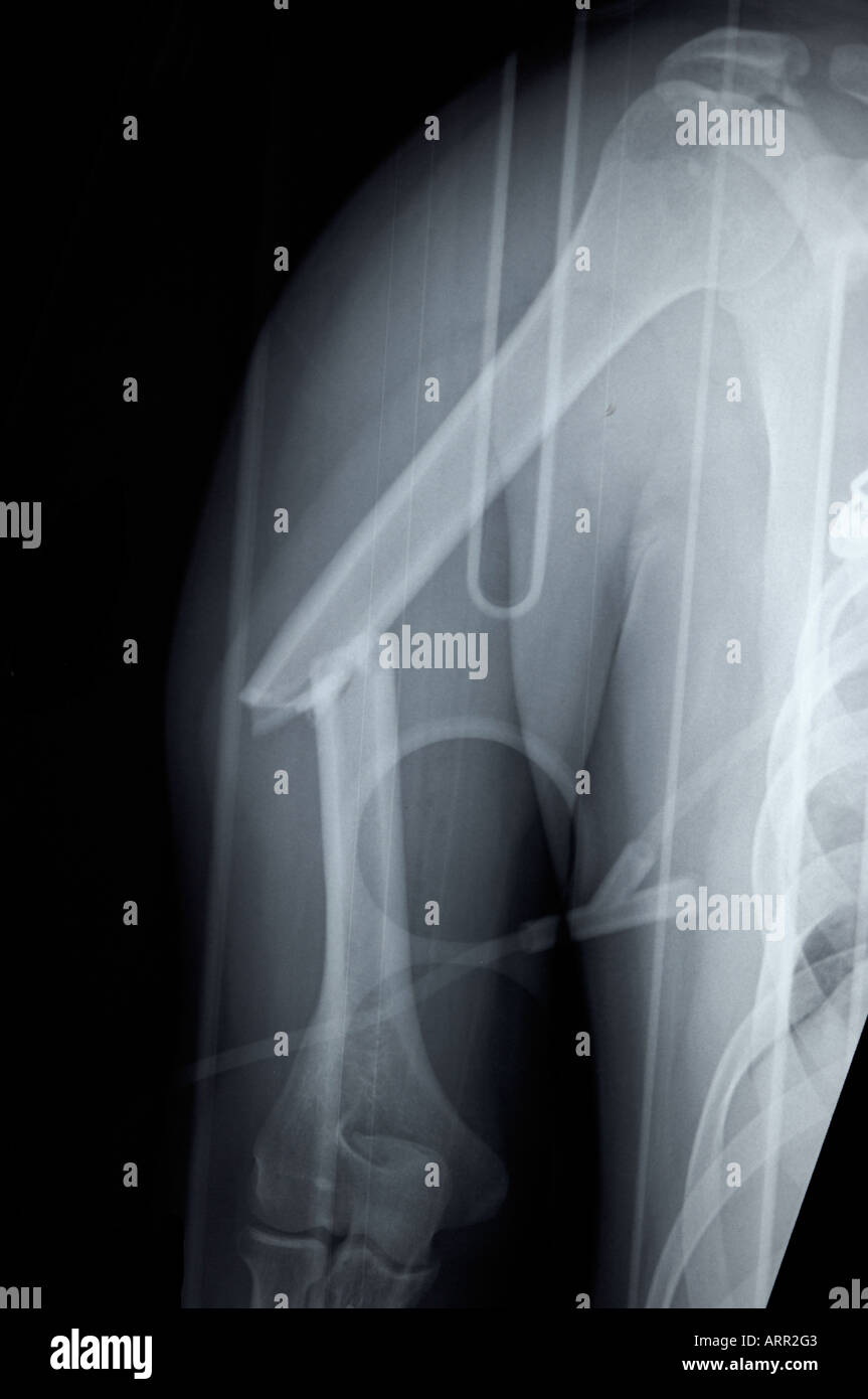 frontal x-ray of midshaft fracture of adult humerus Stock Photo - Alamy