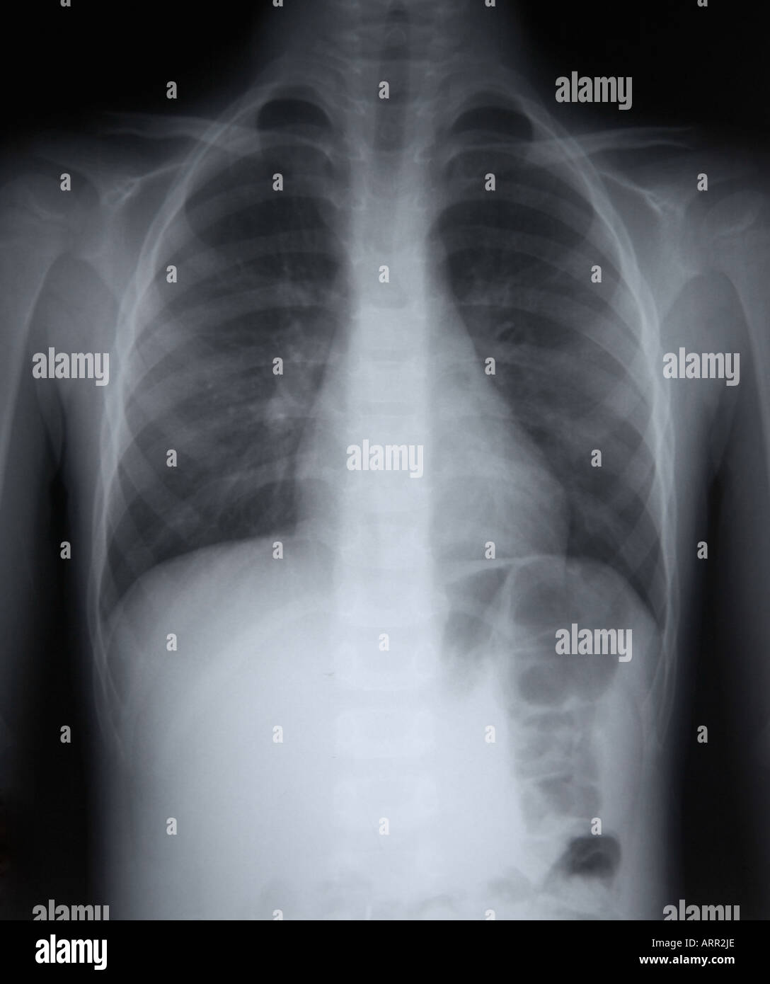 Chest xray ribs lungs hi-res stock photography and images - Alamy
