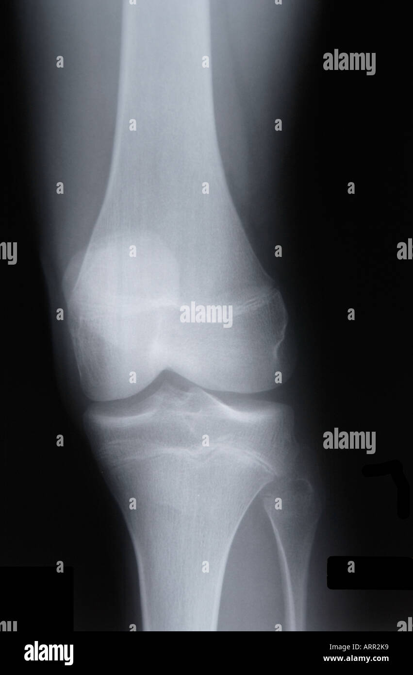 normal internal oblique x-ray of juvenile knee Stock Photo - Alamy
