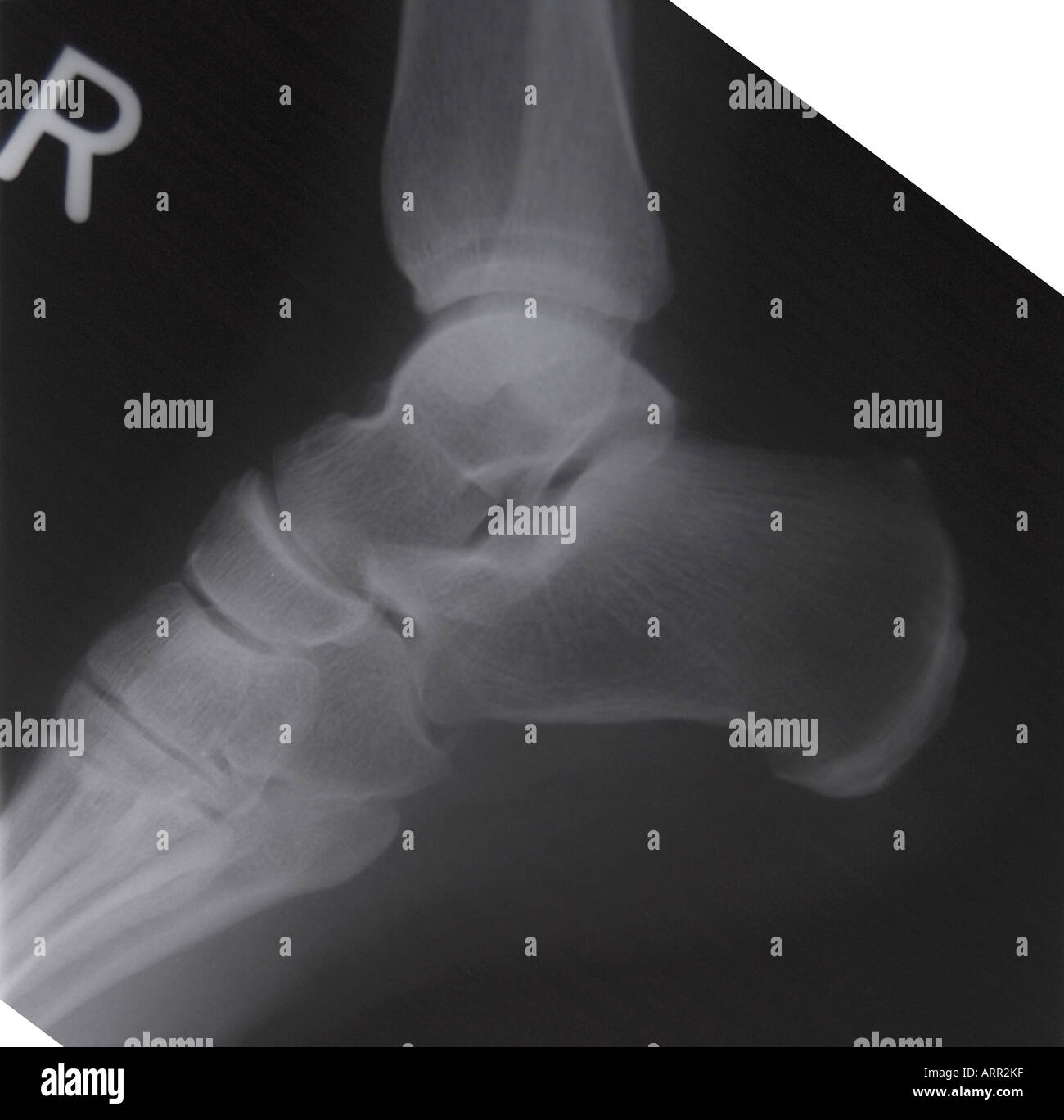 normal lateral x-ray of adult ankle Stock Photo - Alamy