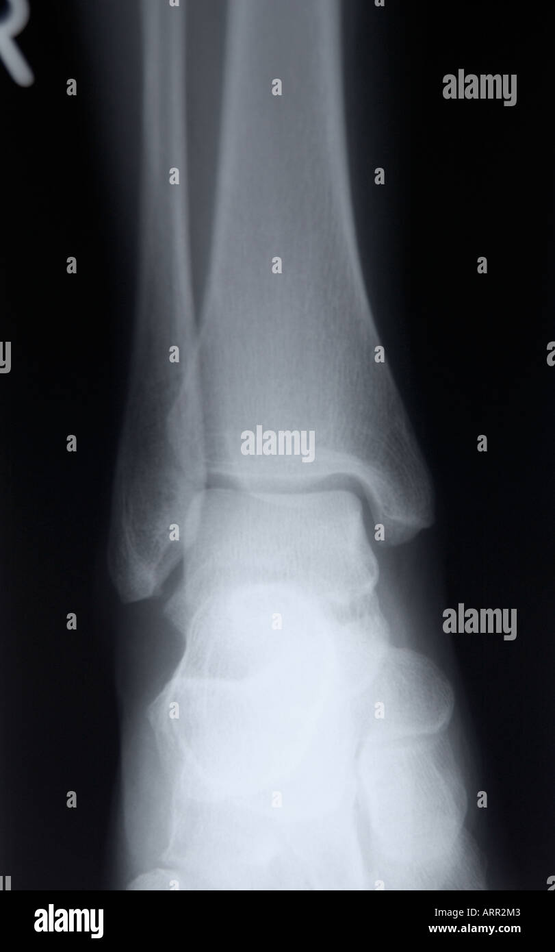 normal frontal x-ray of adult ankle Stock Photo - Alamy