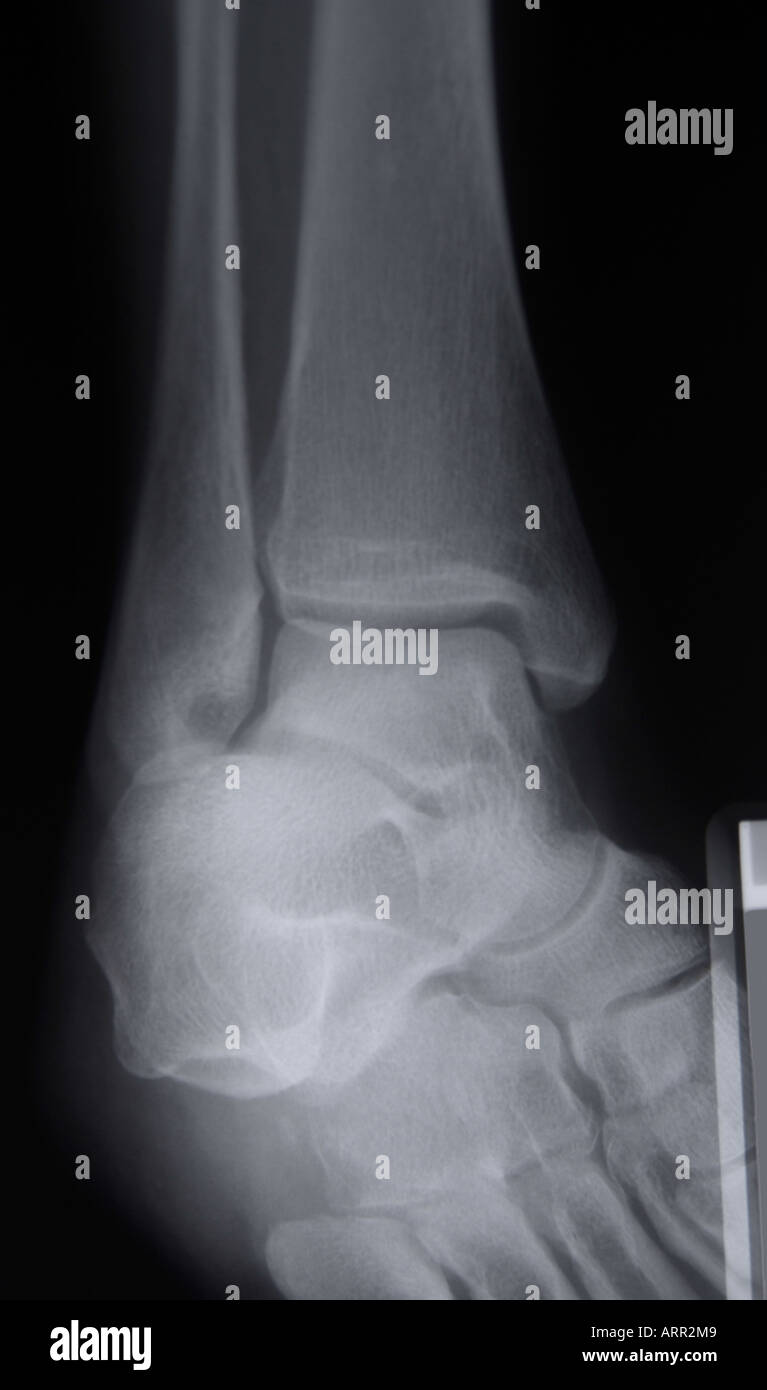 normal x-ray of oblique adult ankle Stock Photo - Alamy