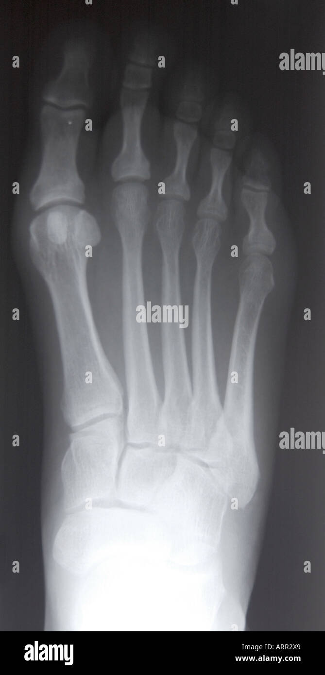 Radiograph foot hi-res stock photography and images - Alamy
