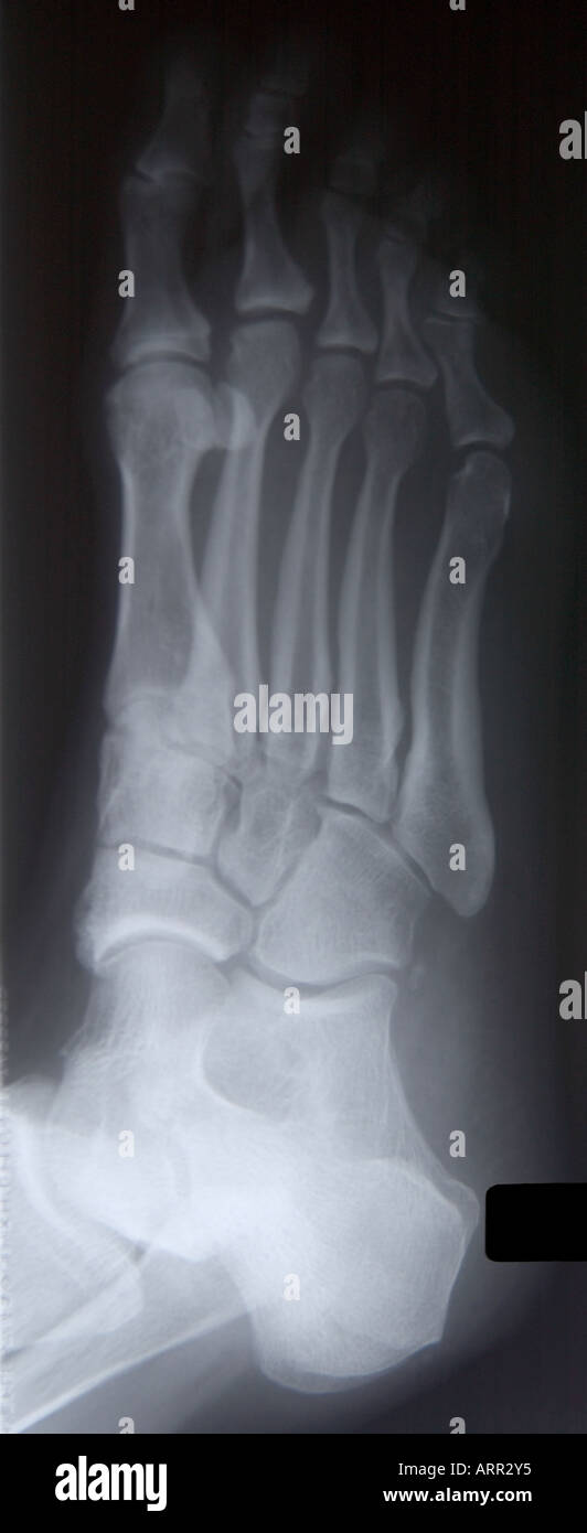 normal oblique x-ray of adult foot Stock Photo - Alamy