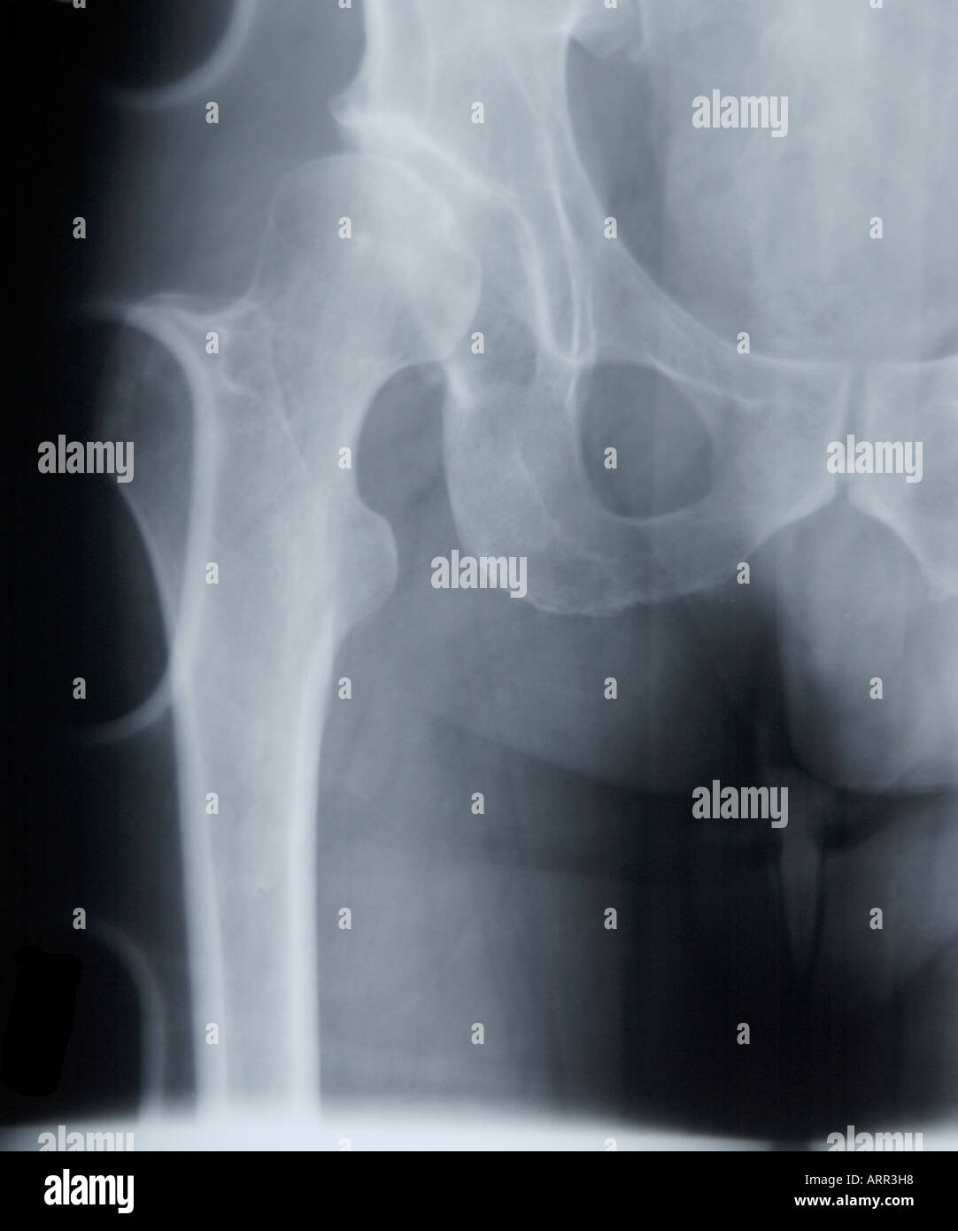 X Ray Left Hip