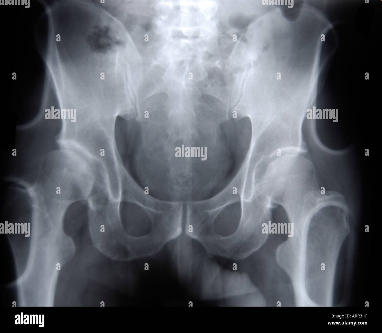 X Ray Pelvis Both Hip Ap Sales Prices | deborahsilvermusic.com