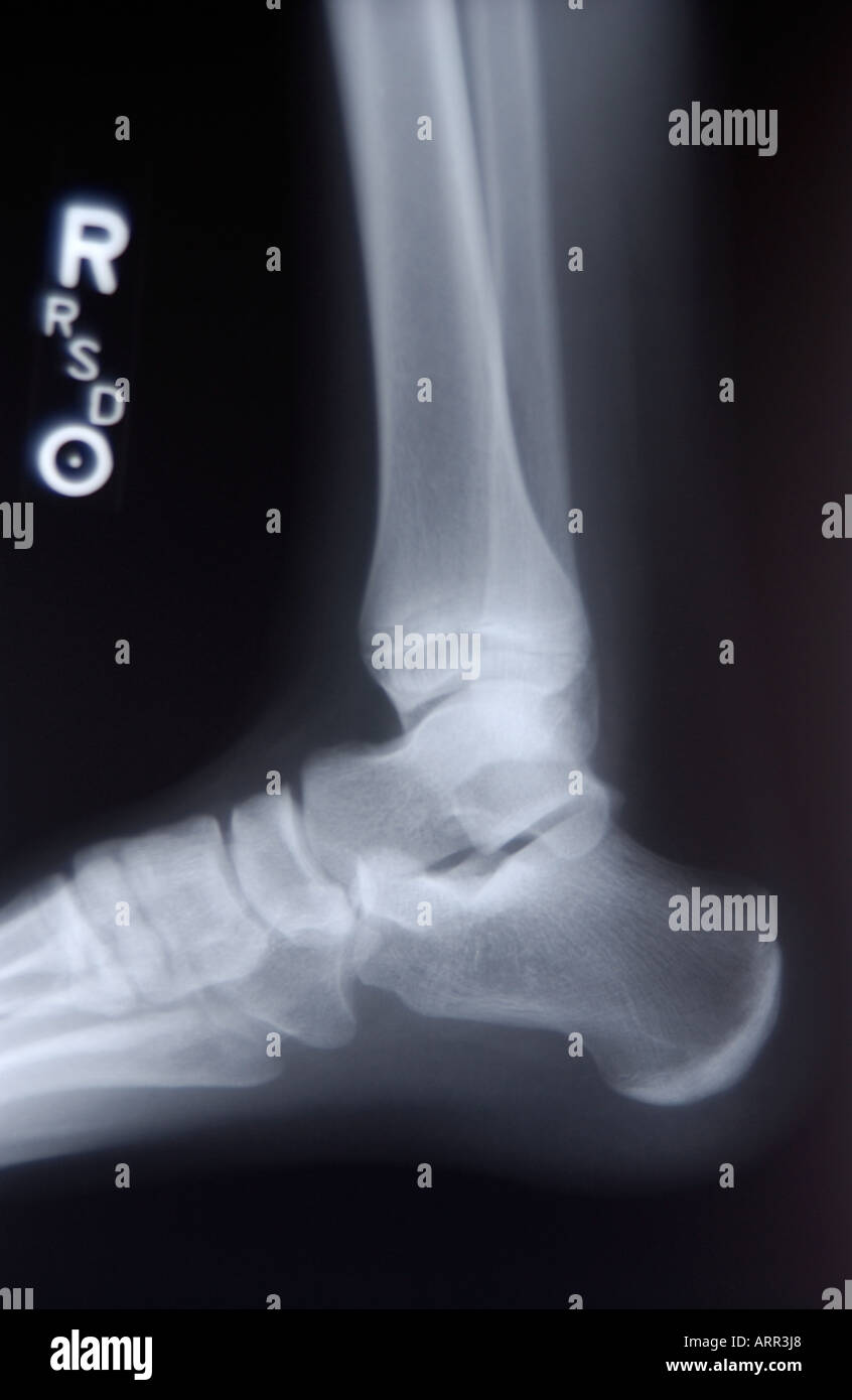 Lateral ankle hi-res stock photography and images - Alamy
