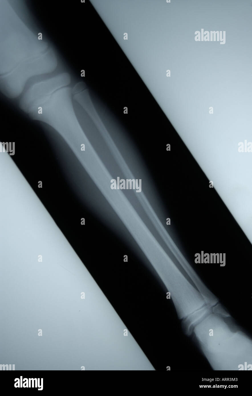 Normal knee xray hi-res stock photography and images - Alamy