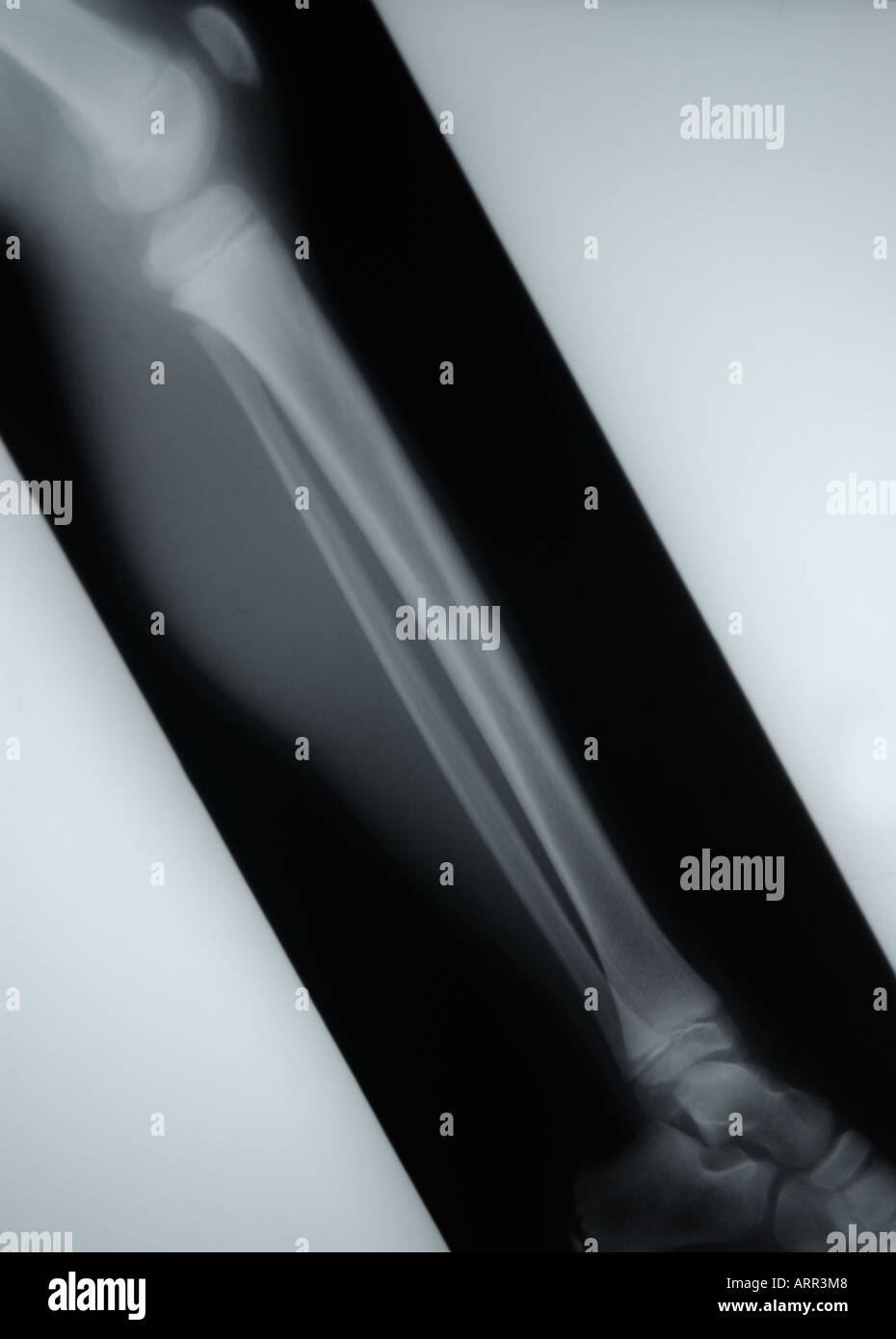 lateral x-ray of juvenile lower leg Stock Photo - Alamy