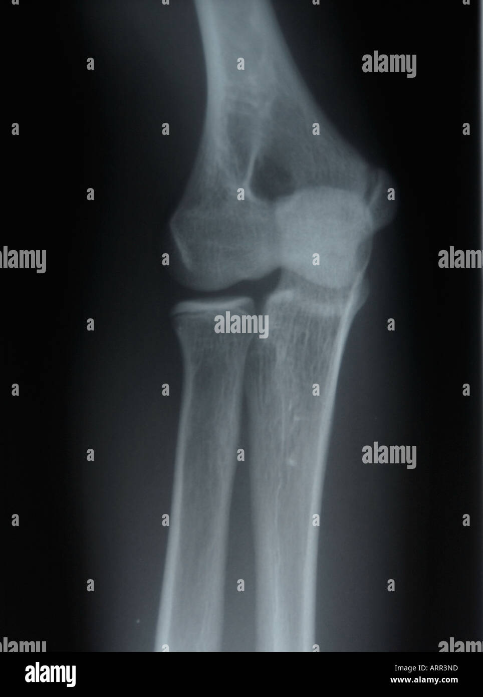 normal oblique x-ray of juvenile elbow Stock Photo - Alamy