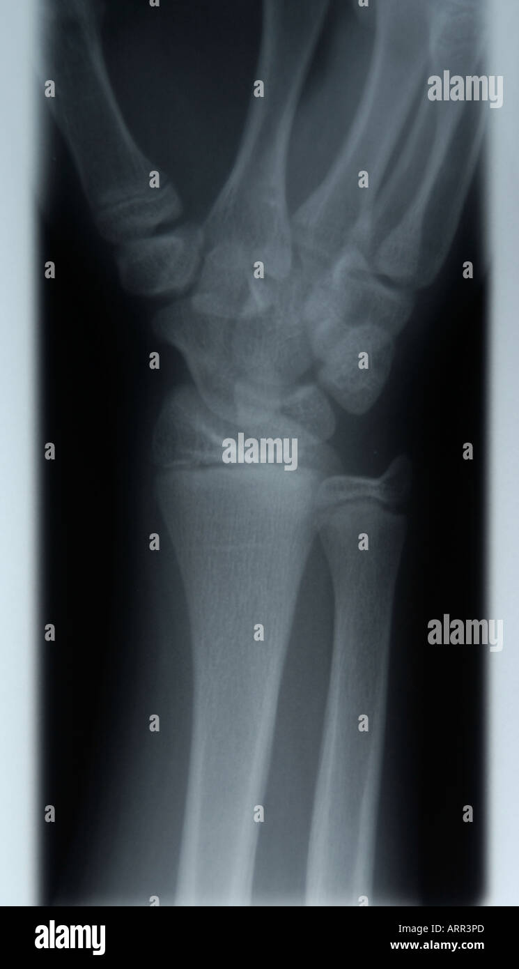 oblique x-ray of normal juvenile wrist Stock Photo - Alamy