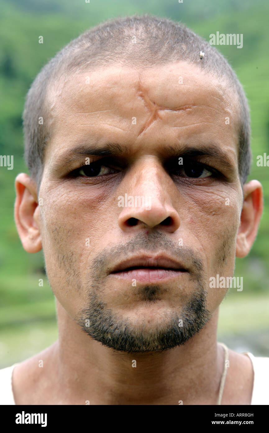 "Nepalese man with a huge scar Stock Photo - Alamy