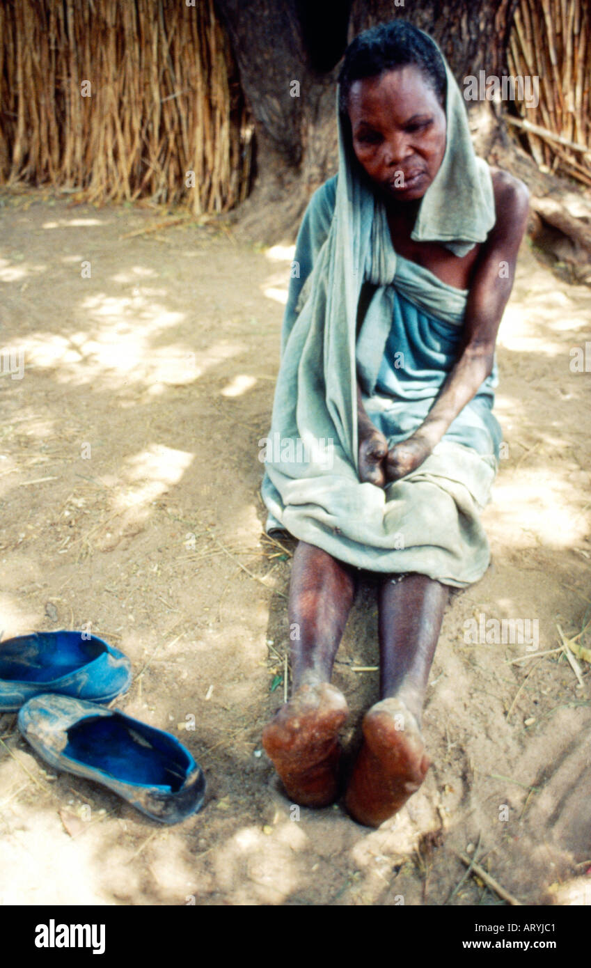 Woman leprosy hi-res stock photography and images - Alamy
