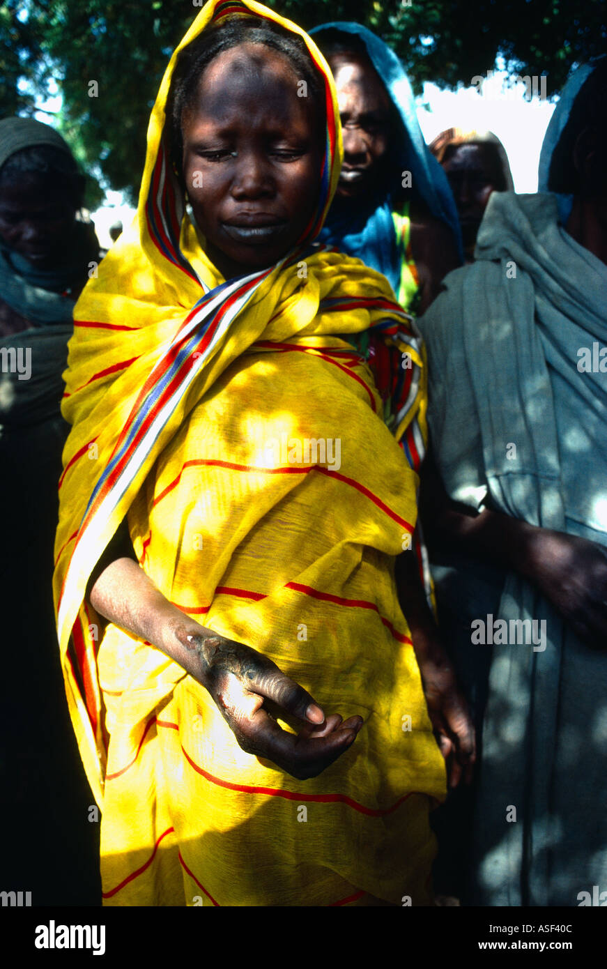 Woman leprosy leper hi-res stock photography and images - Alamy