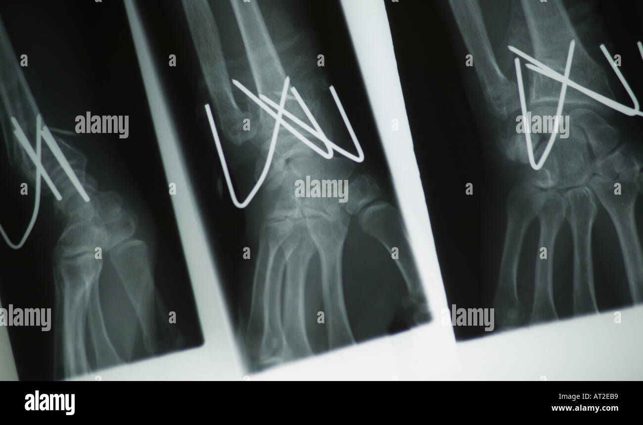 X ray doctor pins hi-res stock photography and images - Alamy