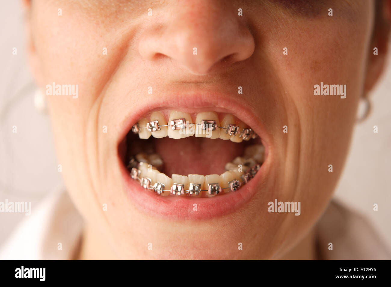 Woman with fixed brace 1 Stock Photo - Alamy