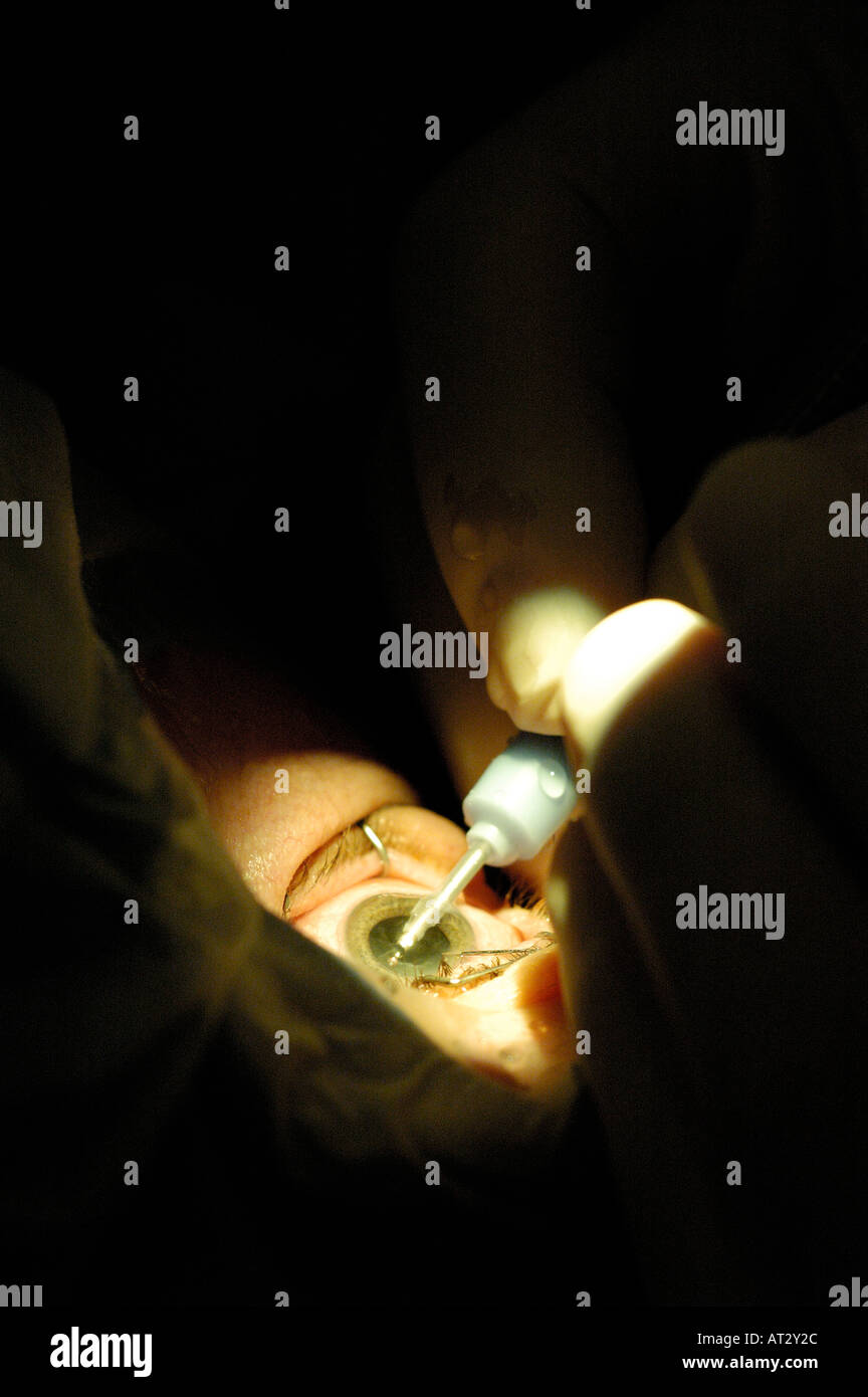 Cataract Surgery Irrigation Aspiration Of Lens of Eye Stock Photo - Alamy