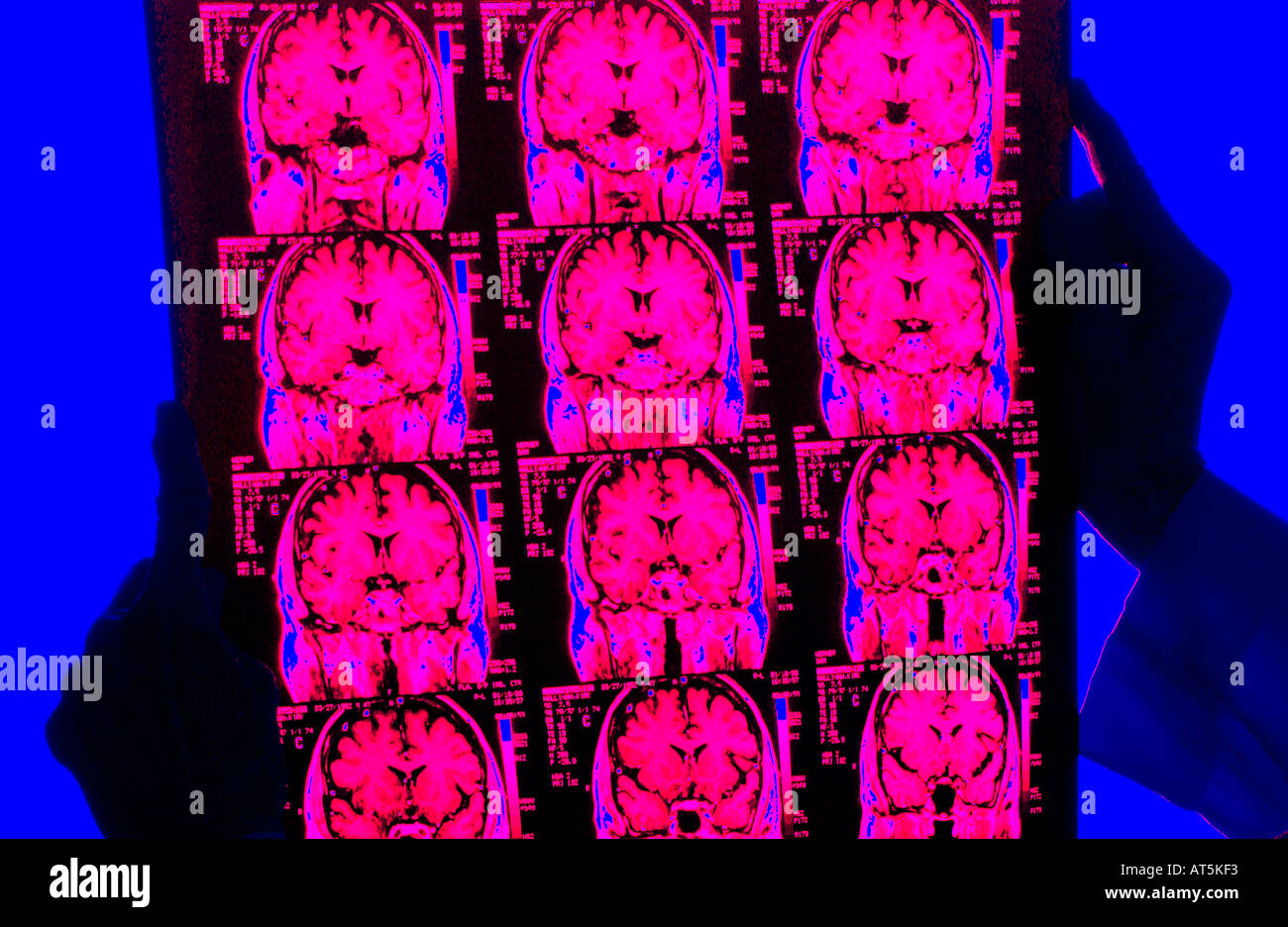 technician examining x-rays of cerebral cortex cerebellum human brain ...