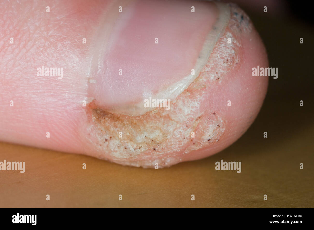 Wart child hi-res stock photography and images - Alamy