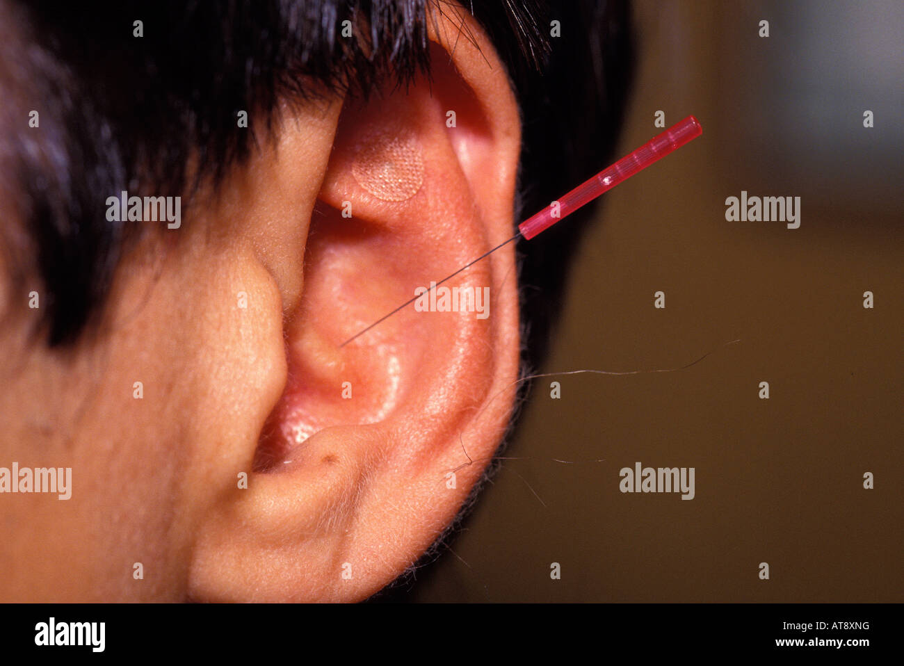 Acupuncture needle in the ear of a man Stock Photo - Alamy
