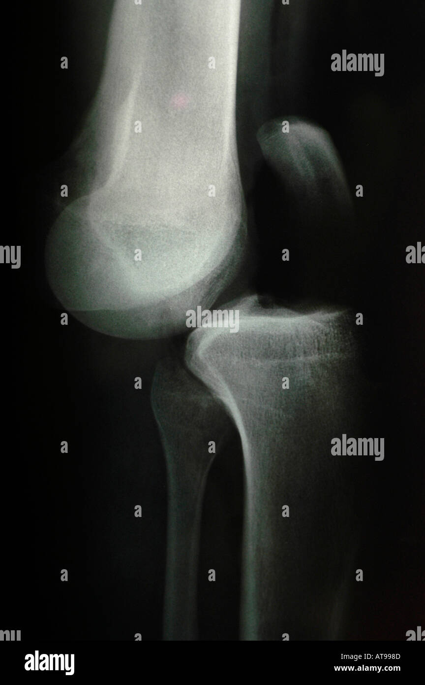Knee dislocation x ray hi-res stock photography and images - Alamy
