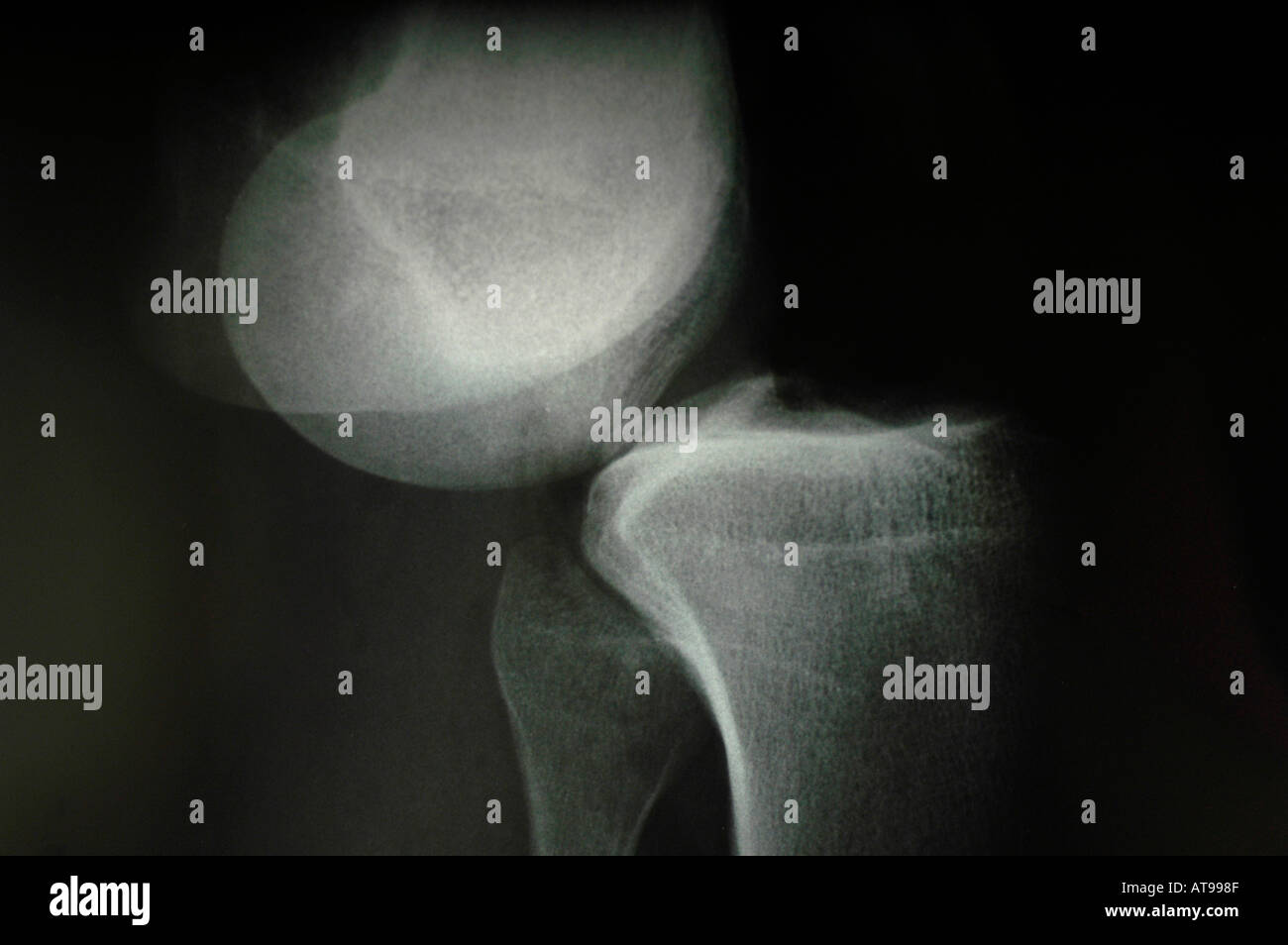X-ray, bone dislocation after accident Stock Photo - Alamy