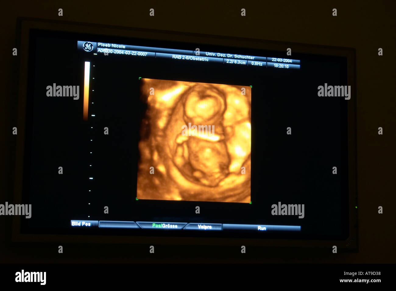 3D ultrasonic scan, 15th week Stock Photo - Alamy