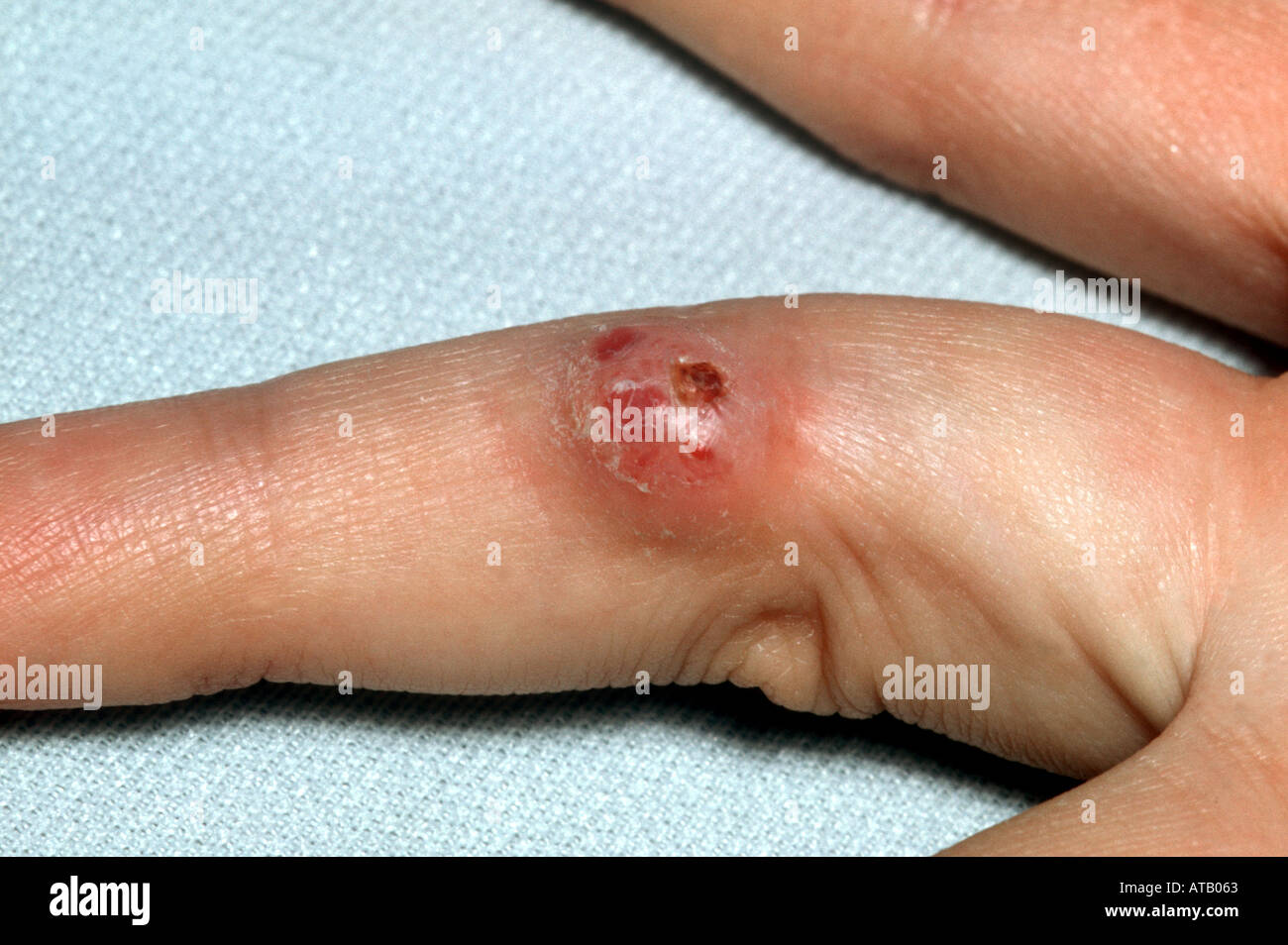 Pyogenic Granuloma Finger