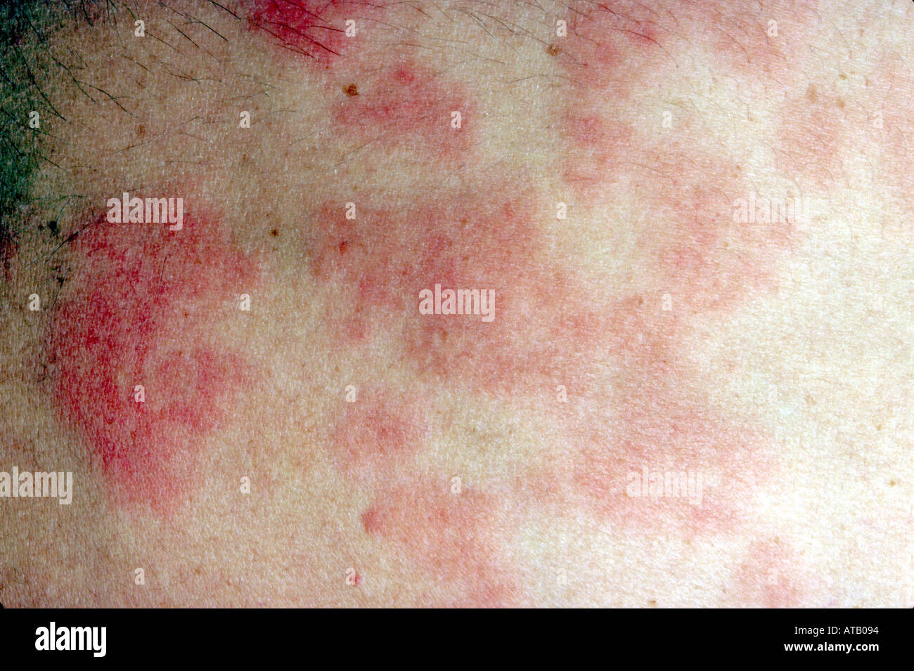 Urticaria hi-res stock photography and images - Alamy