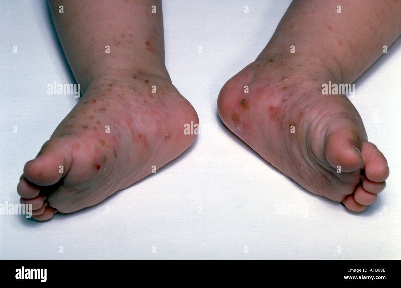 Scabies hi-res stock photography and images - Alamy