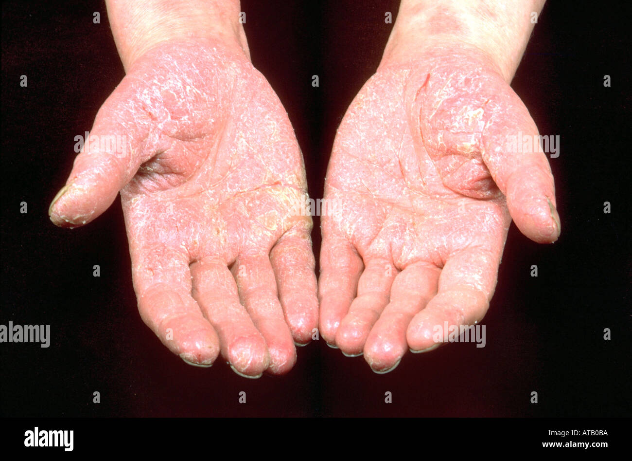 Eczematous hi-res stock photography and images - Alamy